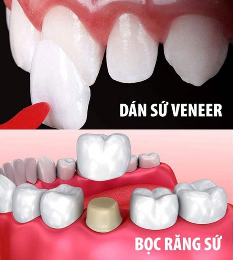 Những tác dụng của bọc răng sứ tuyệt vời như thế nào?
